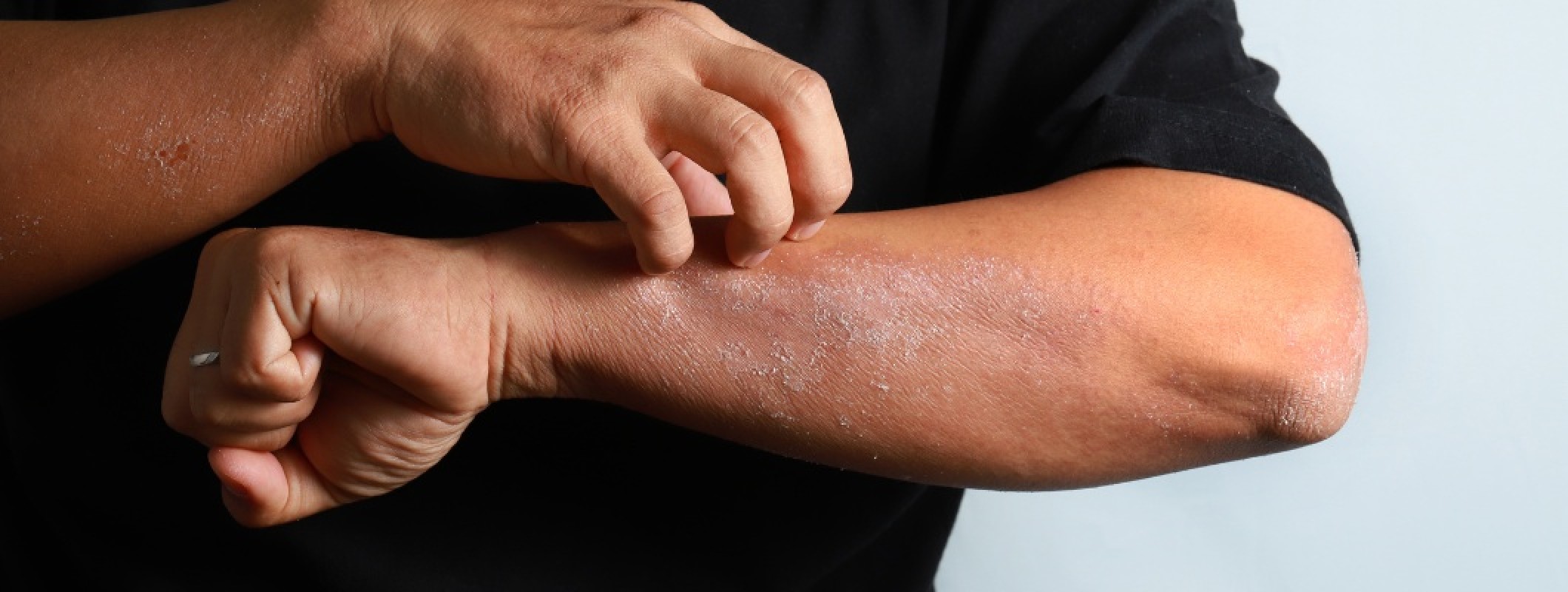 ᐉ Eczeem: Hoe Herkennen En Effectief Behandelen - Benepura.nl